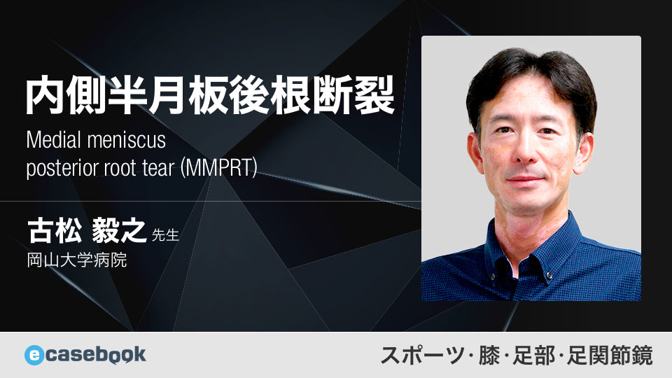 VIDEO: 内側半月板後根断裂 Medial meniscus posterior root tear (MMPRT ...